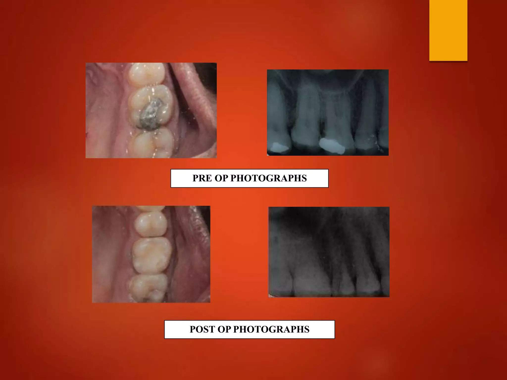 01 MANAGEMENT subgingival caries.pptx