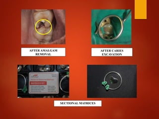 01 MANAGEMENT subgingival caries.pptx