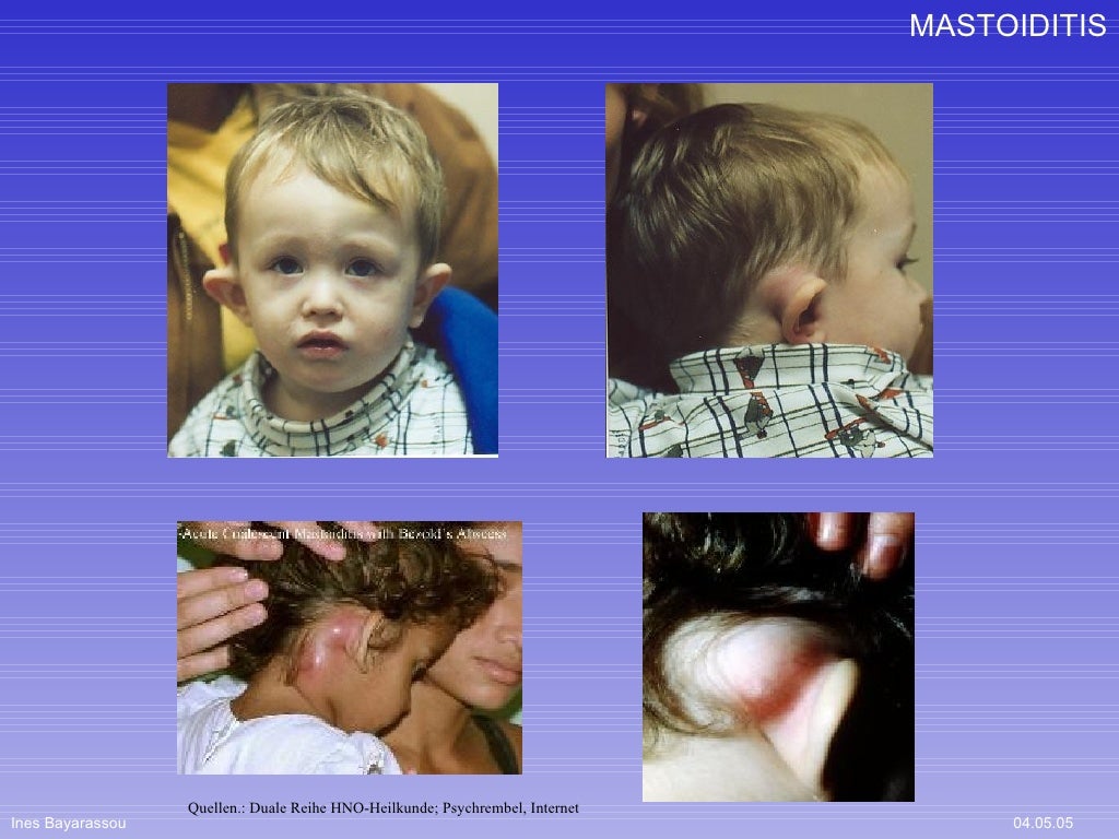 01 mastoiditis