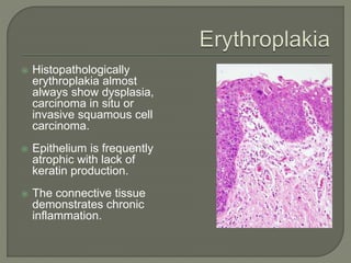 Erythroplakia Histopathology