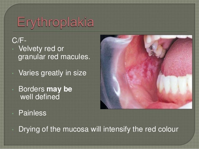 Red lesion of oral mucosa