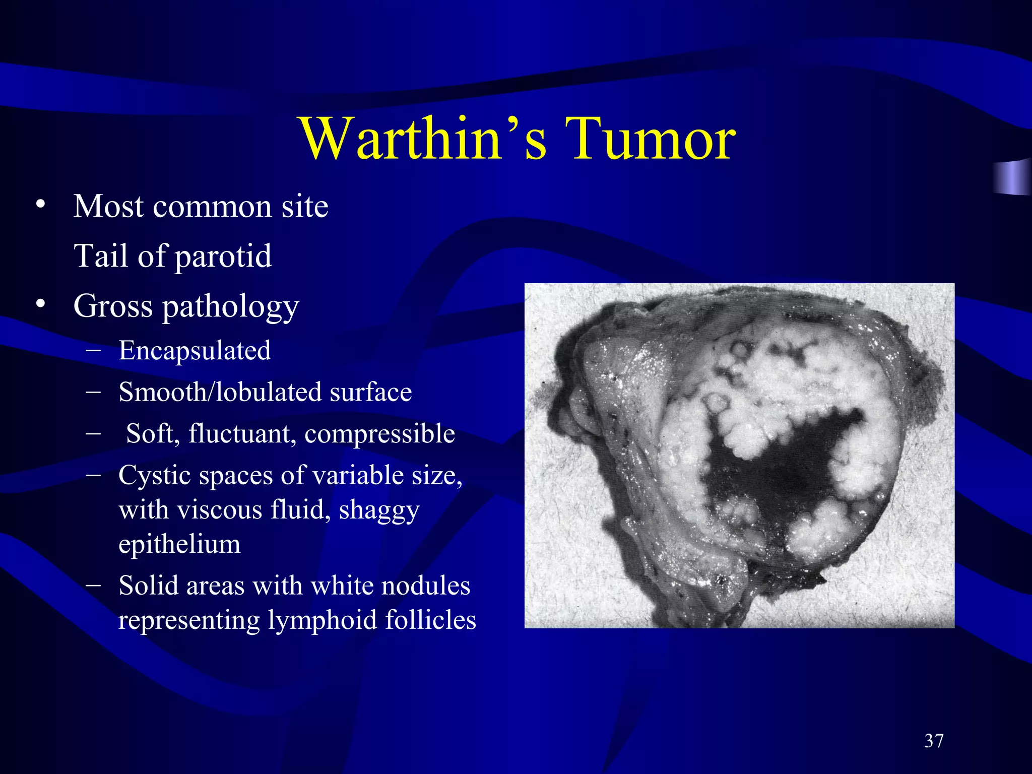 01 salivary gland tumors | PPT
