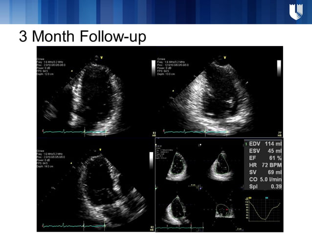 Duke Cardiac Imaging Symposium - Strain Reveals New Information | PPT ...