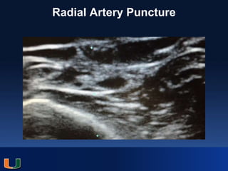 01 technical Cohen aimradial20170922 Ultrasound based puncture | PPT