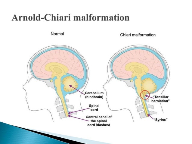 ARNOLD CHIARI MALFORMATION-STRUCTURAL DEFECTS IN BRAIN AND SPINAL CORD ...