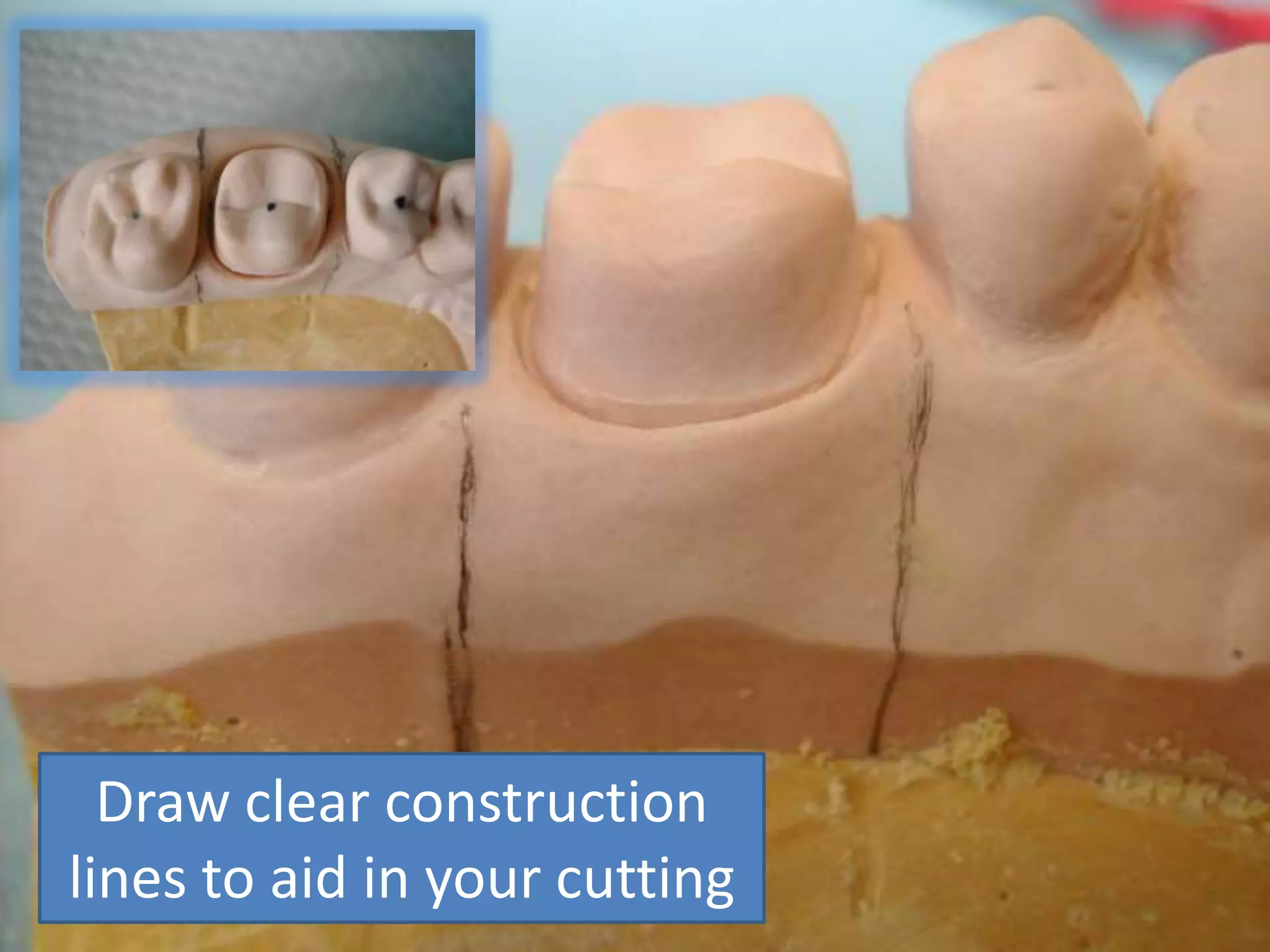 02 02 sectioning a crown model | PPTX