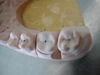 02 02 sectioning a crown model | PPTX