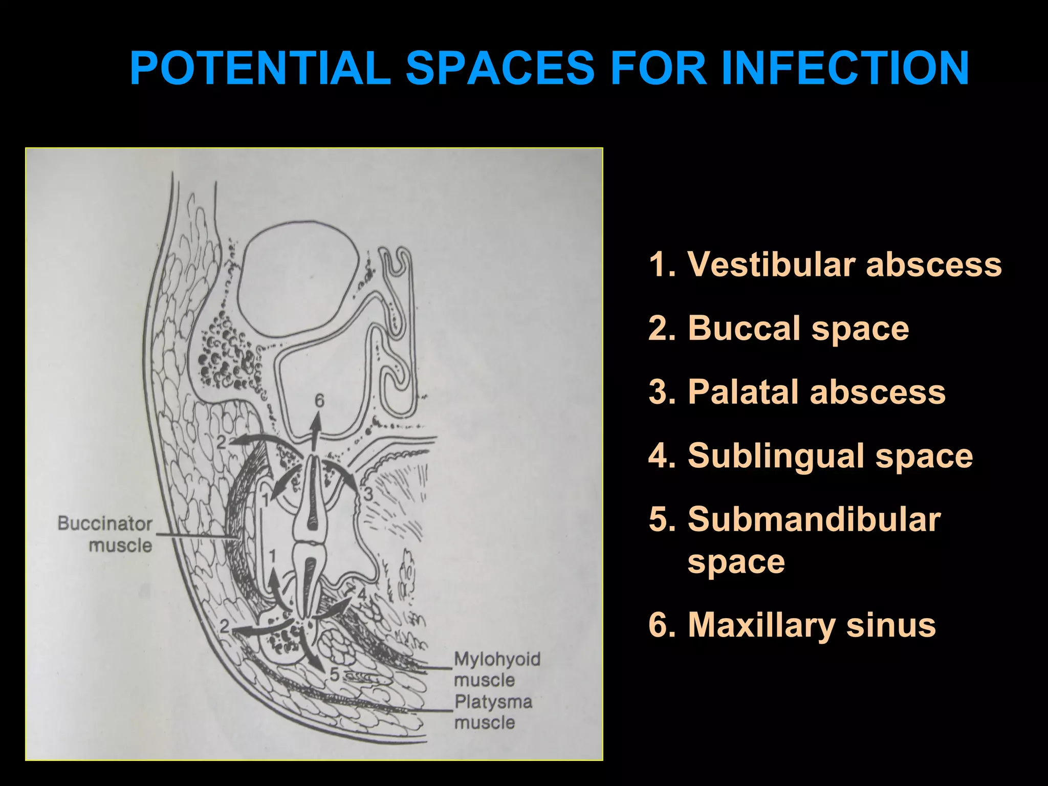 02.space infections clinical features & treatment | PPT