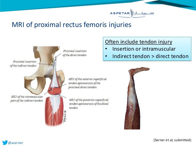 Andreas Serner - Rectus Femoris Injuries Experiencies (Aspetar)