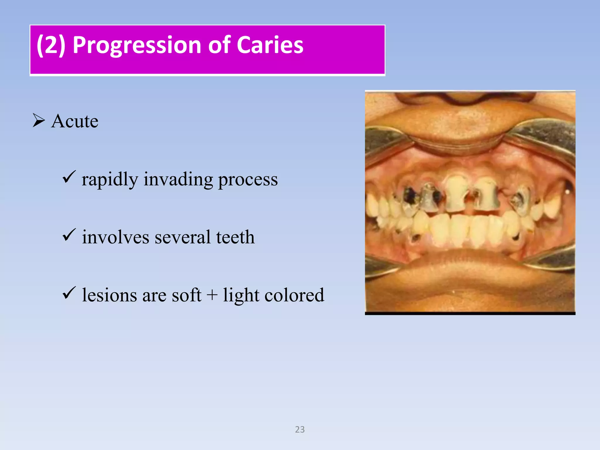 02.dental caries | PPTX