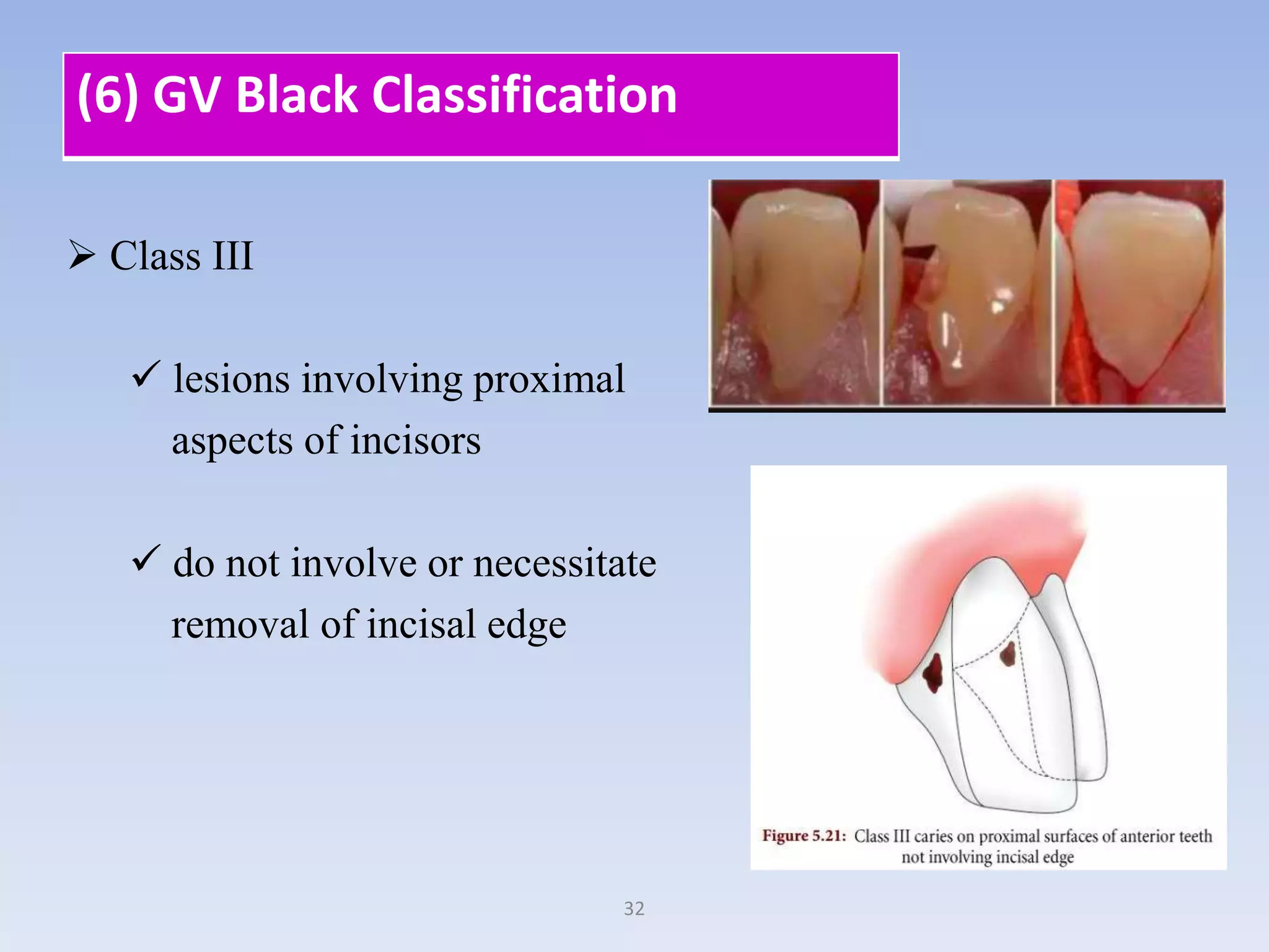 02.dental caries | PPTX