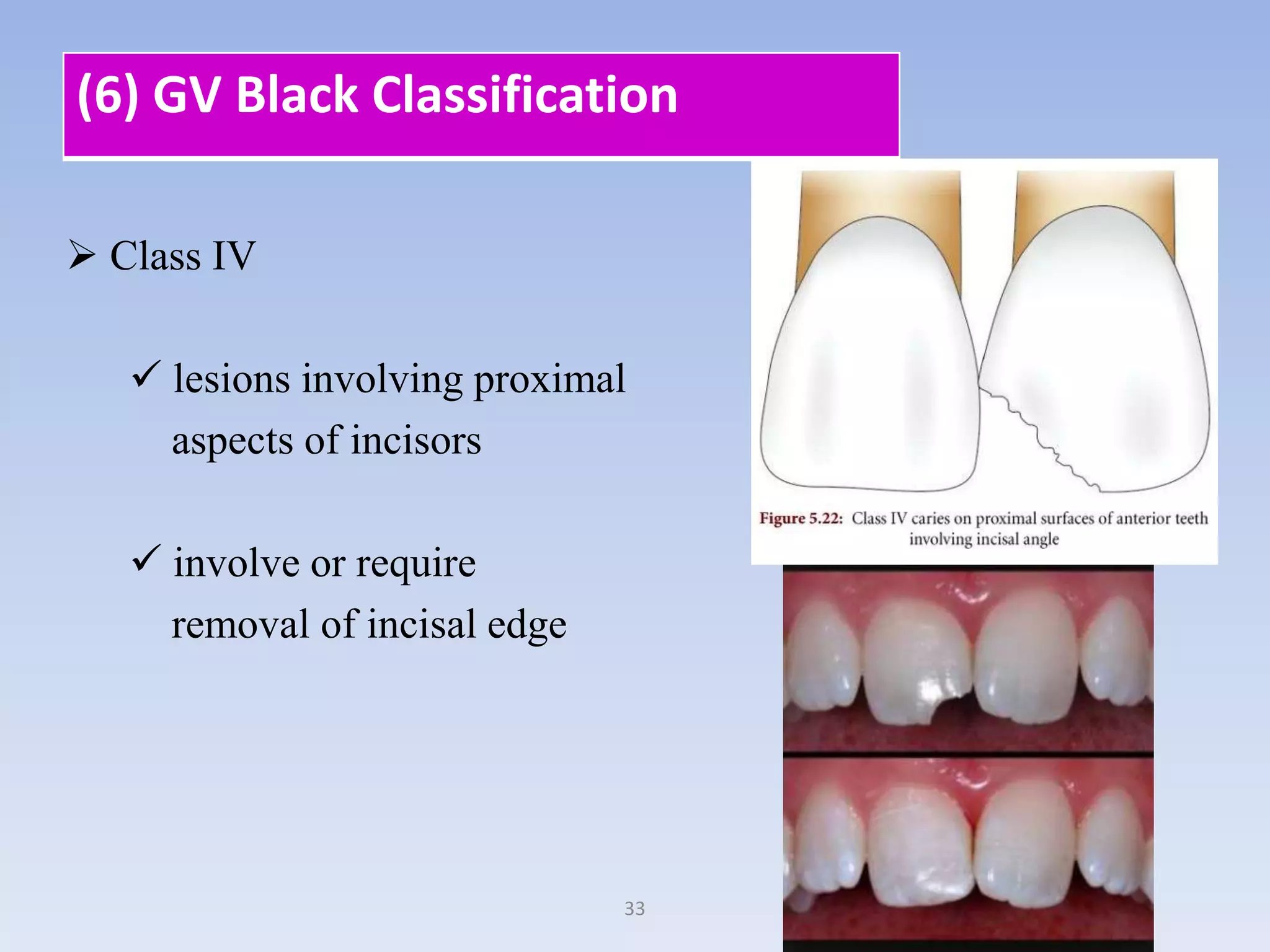02.dental caries | PPTX