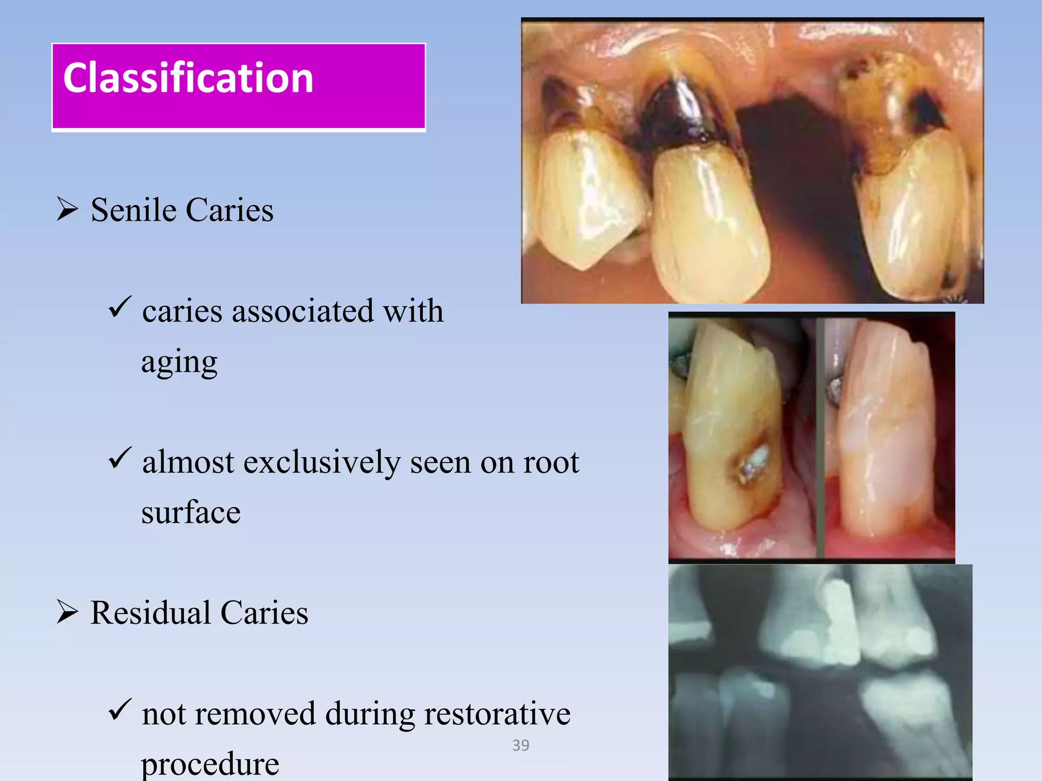 02.dental caries | PPTX