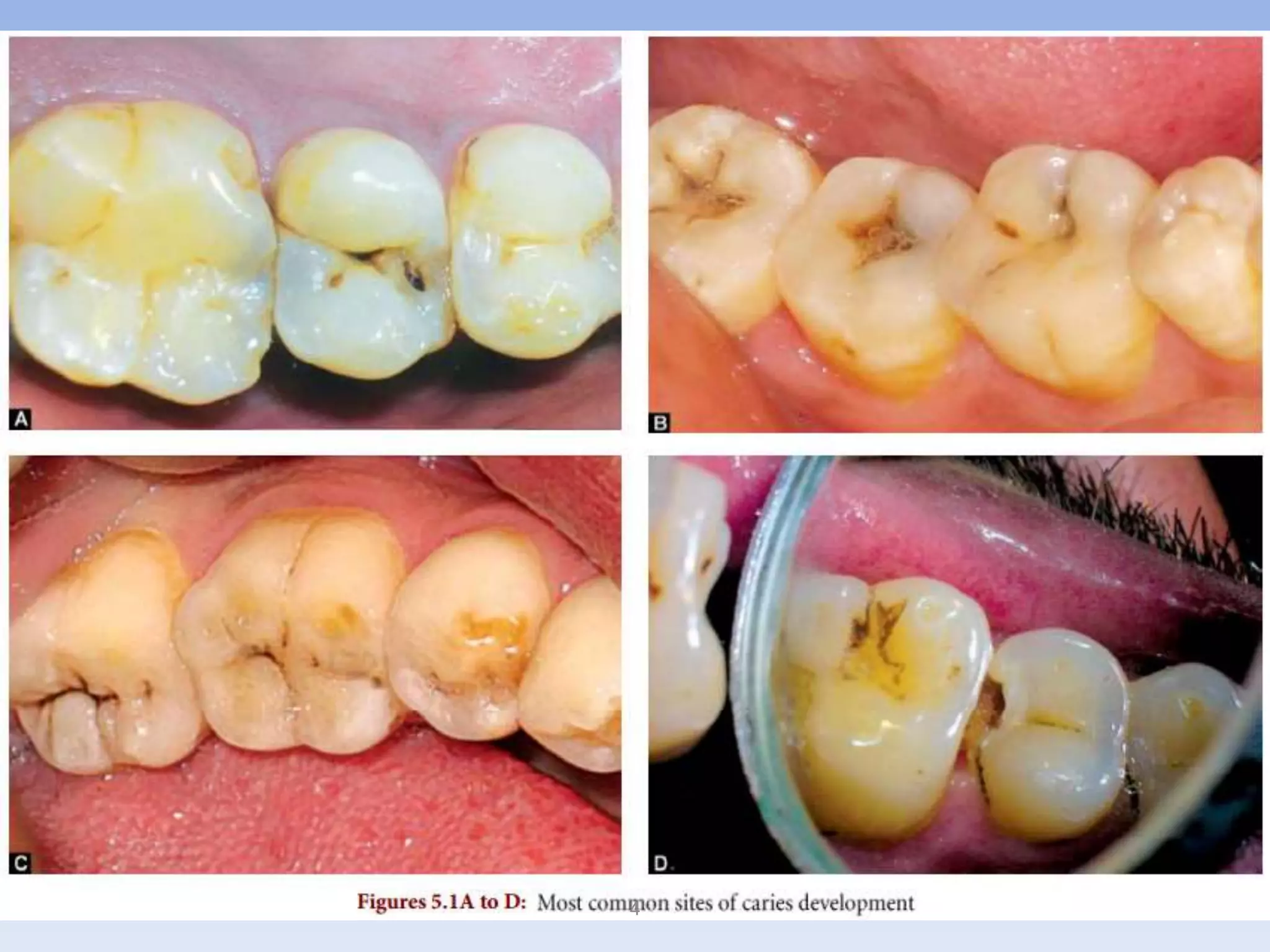 02.dental caries | PPTX
