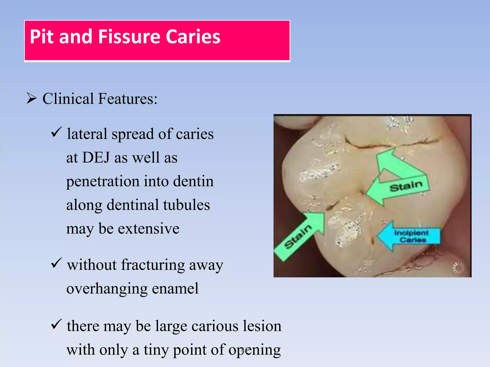 02.dental caries | PPTX