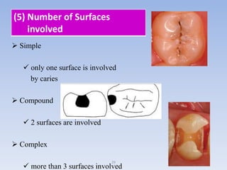 02.dental caries | PPTX