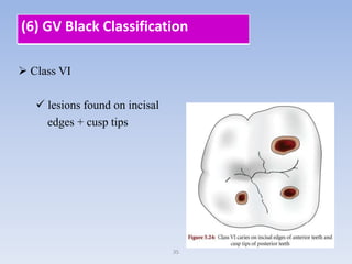 02.dental caries | PPTX