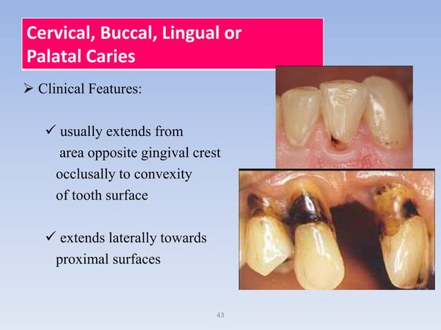 02.dental caries | PPTX