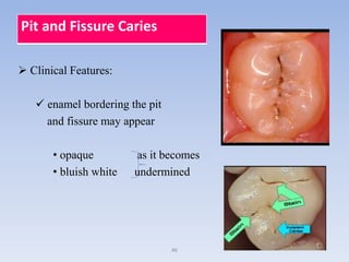 02.dental caries | PPTX