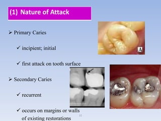 Recurrent Caries