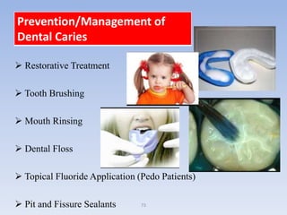 Dental Caries Treatment Ppt