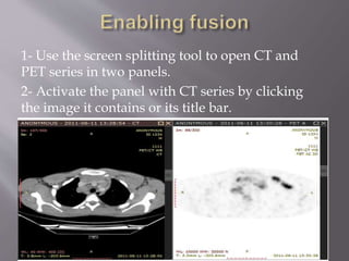 Nuclear Medicine - PET/CT | PPTX