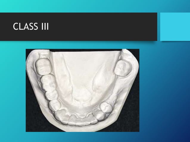 02. kennedy classification | PPTX | Dental Health | Diseases and Conditions