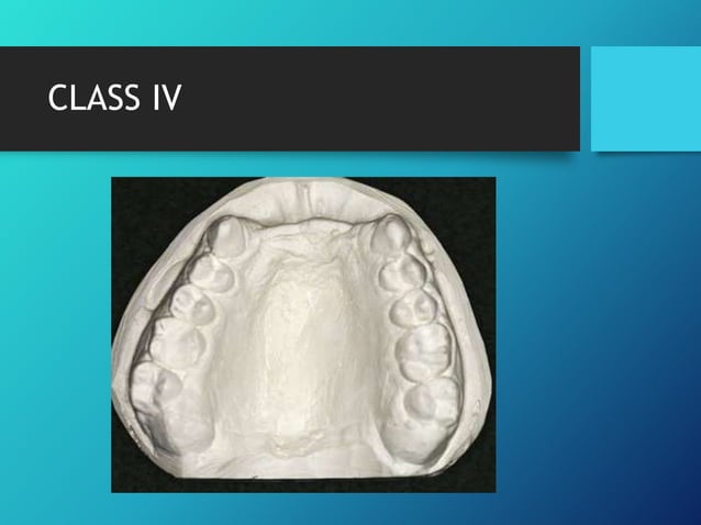 02. kennedy classification | PPTX | Dental Health | Diseases and Conditions