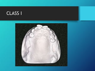 02. kennedy classification | PPTX