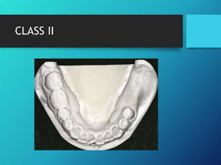 02. kennedy classification | PPTX