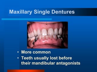 02. Single Complete Denture.pptx
