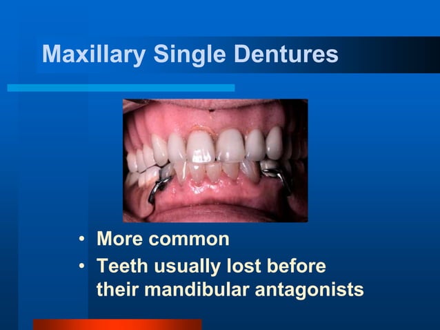 02. Single Complete Denture.pptx | Dental Health | Diseases and Conditions