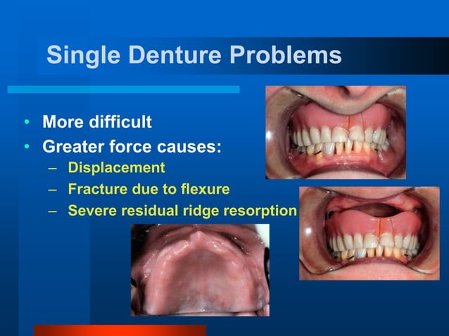 02. Single Complete Denture.pptx | Dental Health | Diseases and Conditions