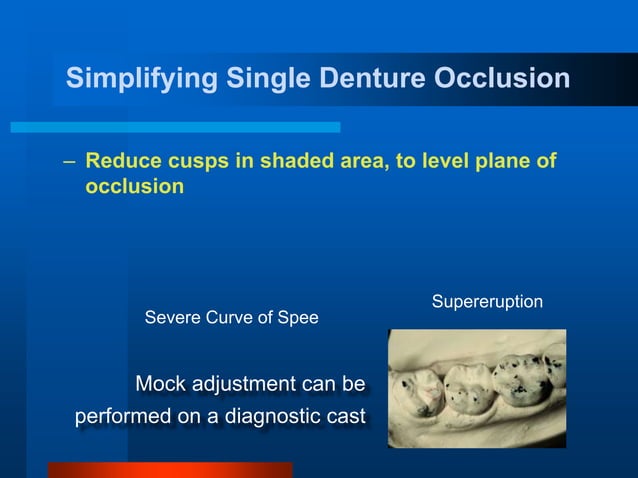 02. Single Complete Denture.pptx | Dental Health | Diseases and Conditions