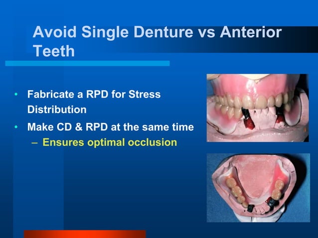 02. Single Complete Denture.pptx | Dental Health | Diseases and Conditions
