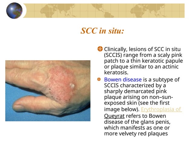 Skin cancer and malignant melanoma management | PPT