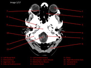 02-CT Brain - Axial anatomy radiology.pdf