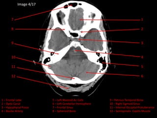 02-CT Brain - Axial anatomy radiology.pdf