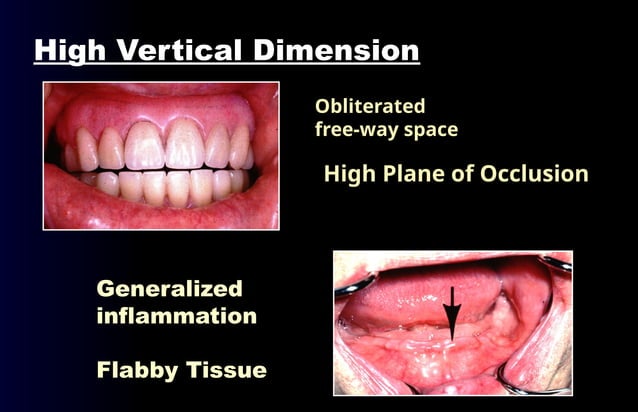 02- Definitions (Occlusion in prosthodontics) .pptx