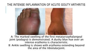 02-Gouty arthritis.pptx