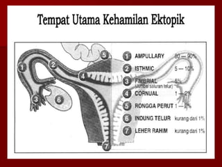 02-Kehamilan Ektopik - kehamilan di luar | PPT
