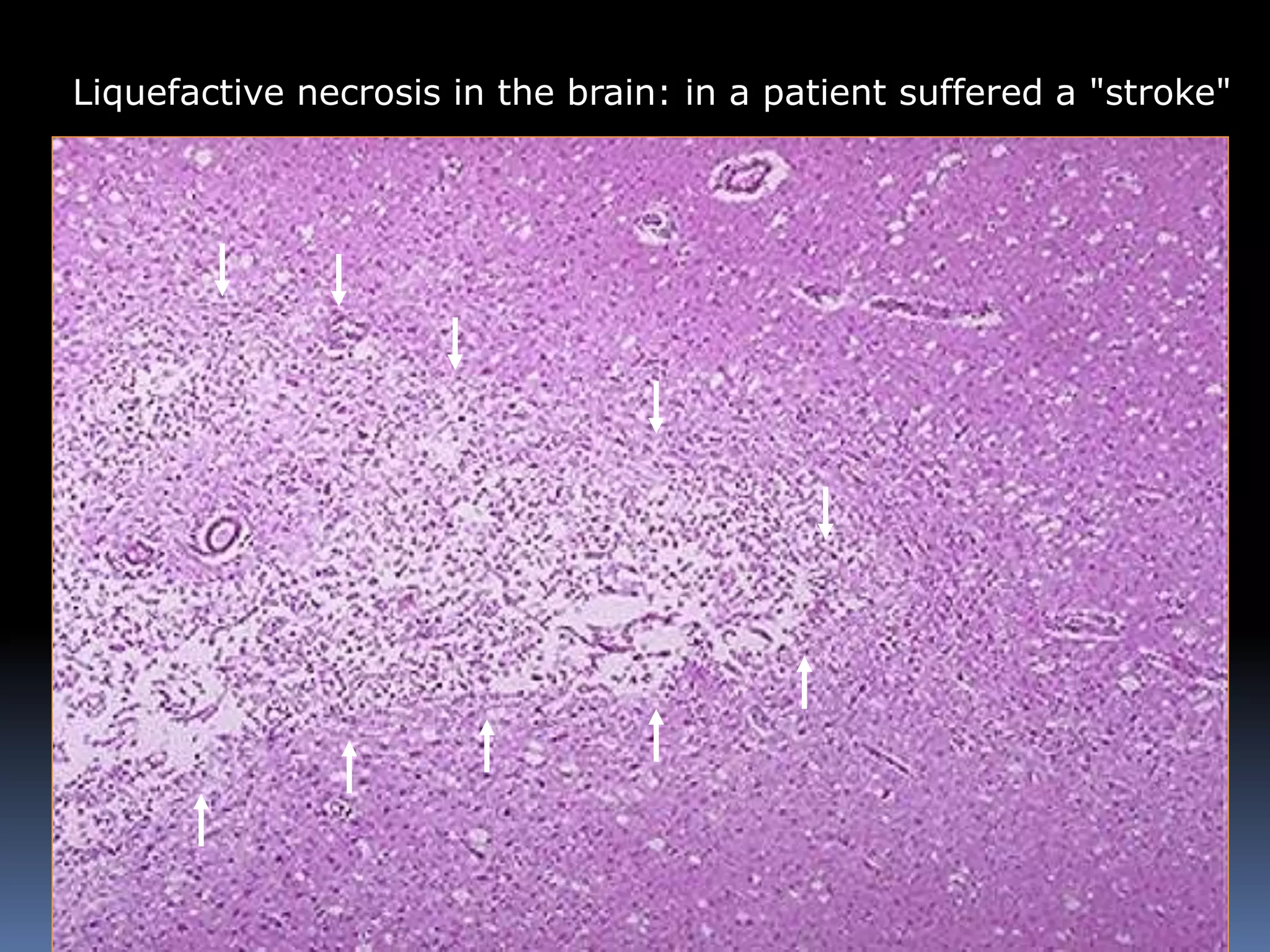 02-Necrosis and apoptosis-1.ppt