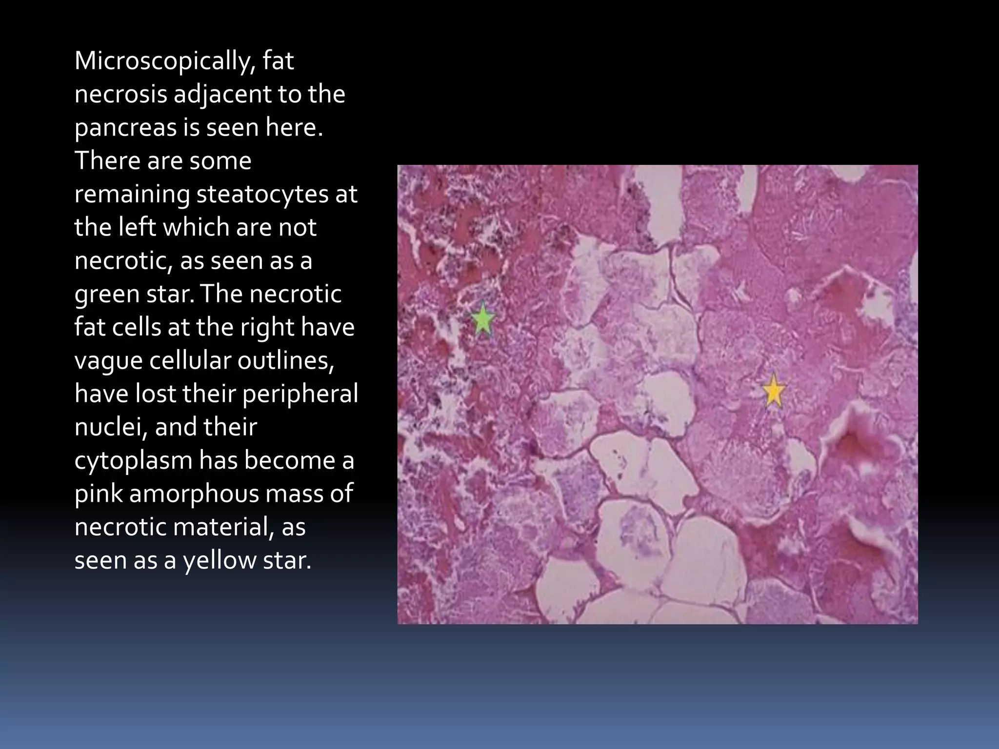 02-Necrosis and apoptosis-1.ppt
