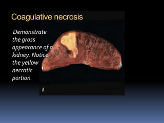 Coagulative Necrosis Gross