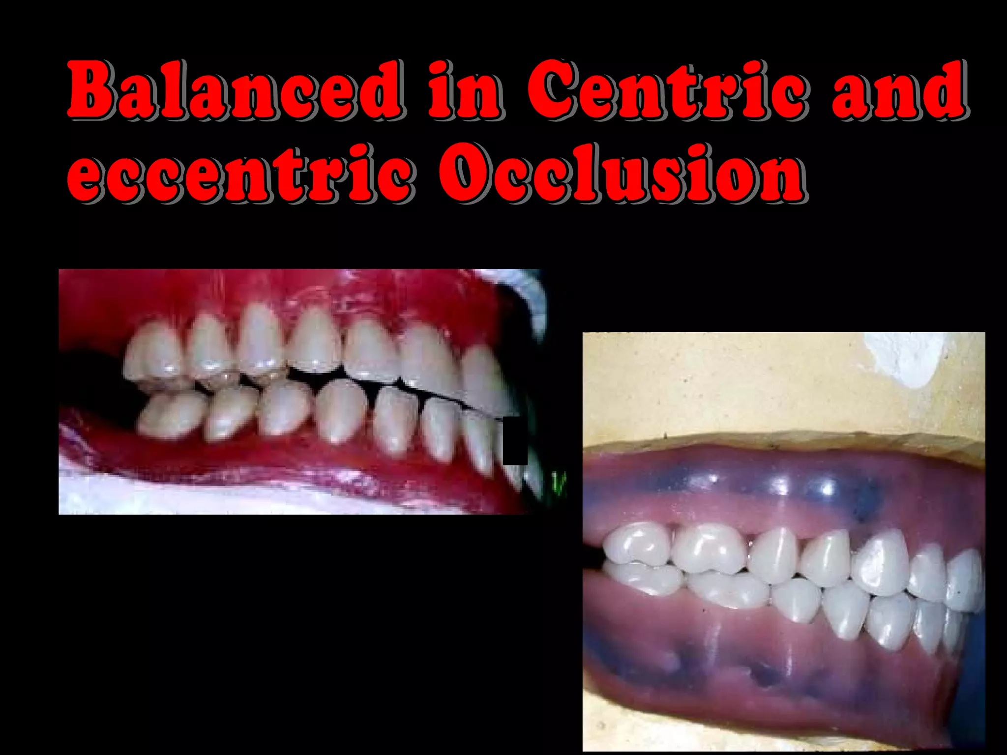 02 occlusion in prosthodontics. balanced occlusion | PPT