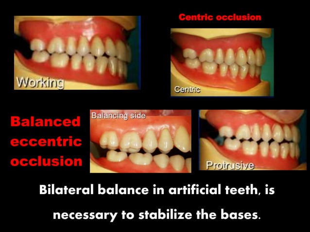 02- Occlusion in prosthodontics. Balanced occlusion | PPT