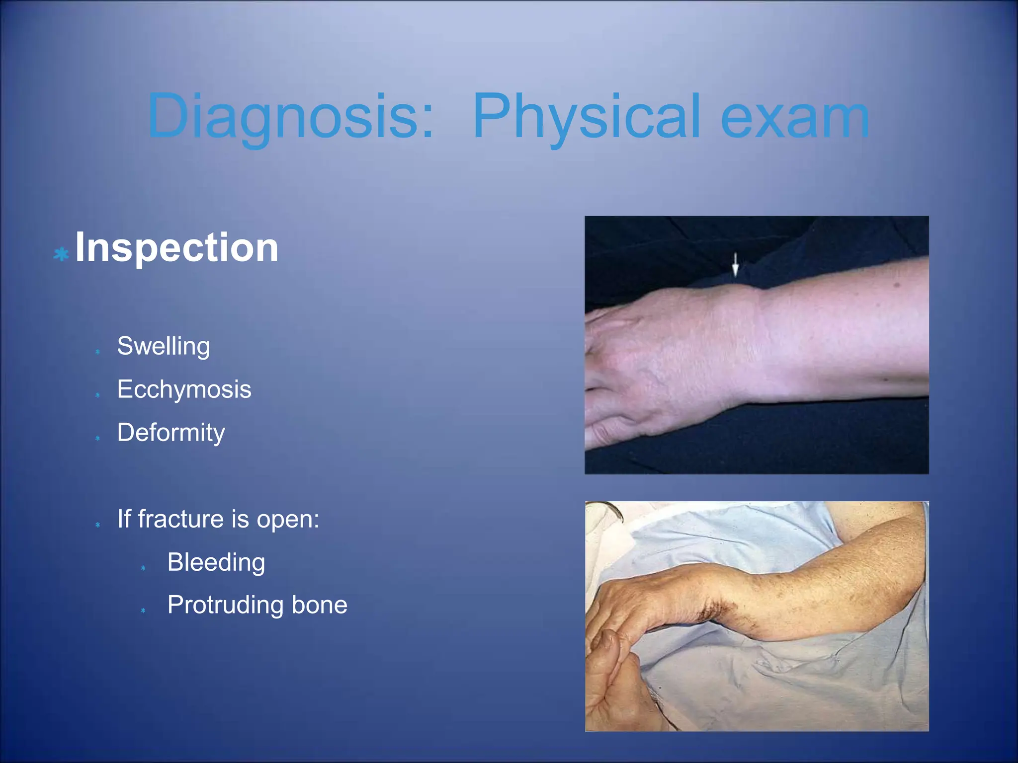 Principles of Fractures. Principle of Fractures | PPT