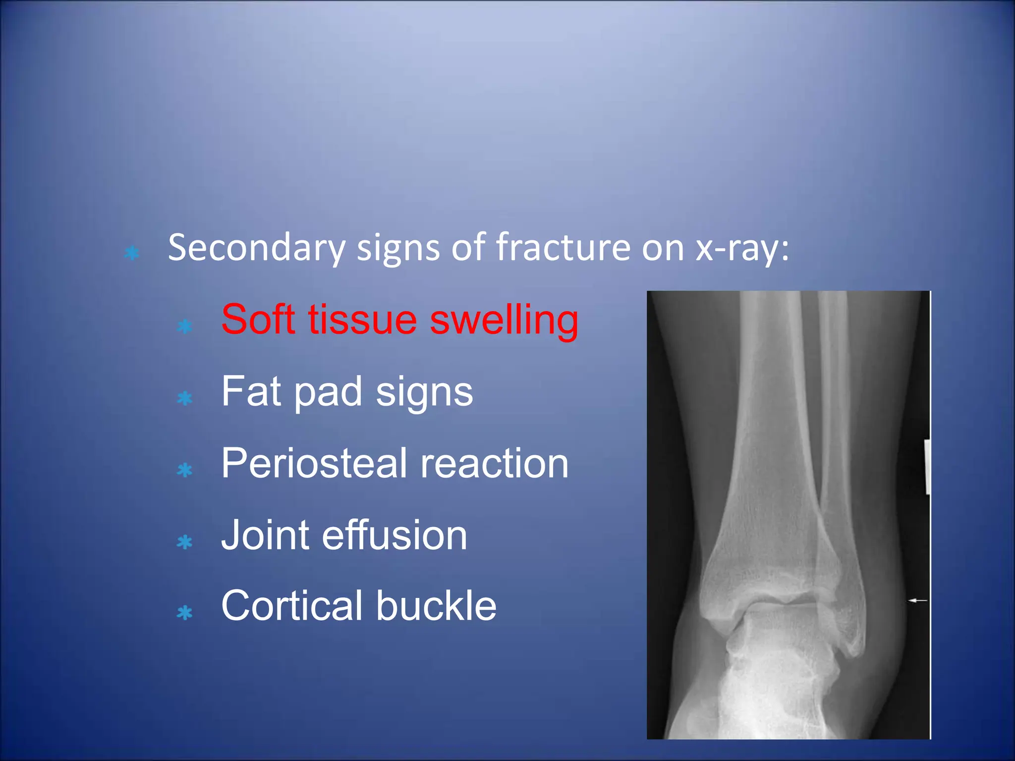Principles of Fractures. Principle of Fractures | PPT