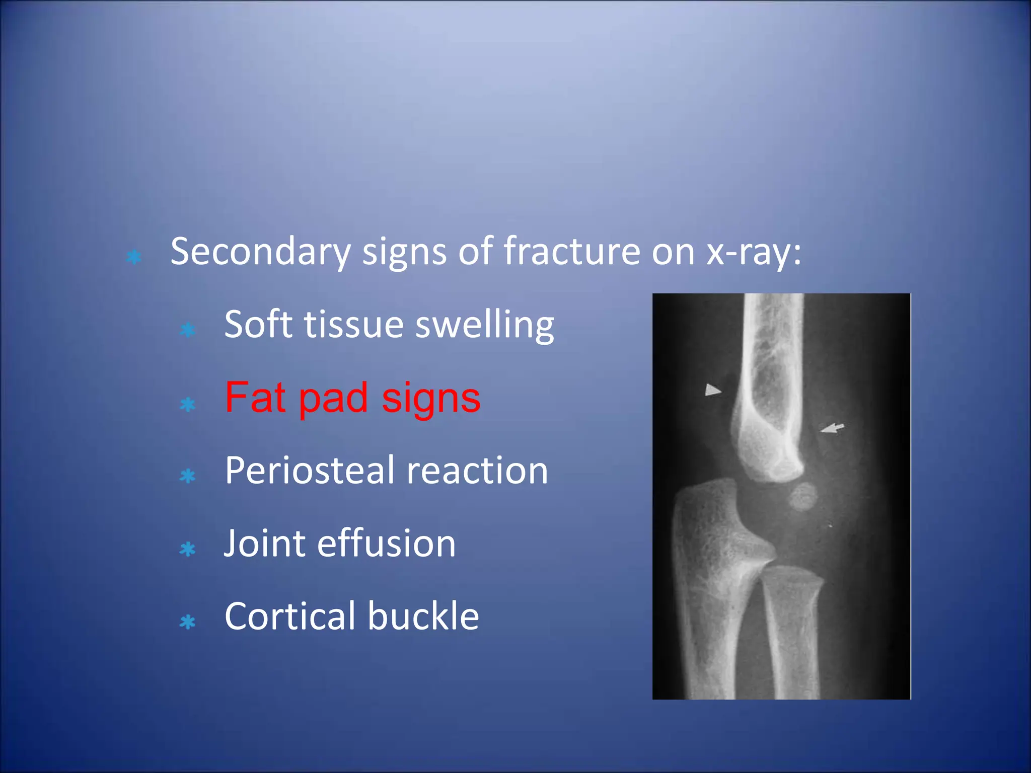 Principles of Fractures. Principle of Fractures | PPT