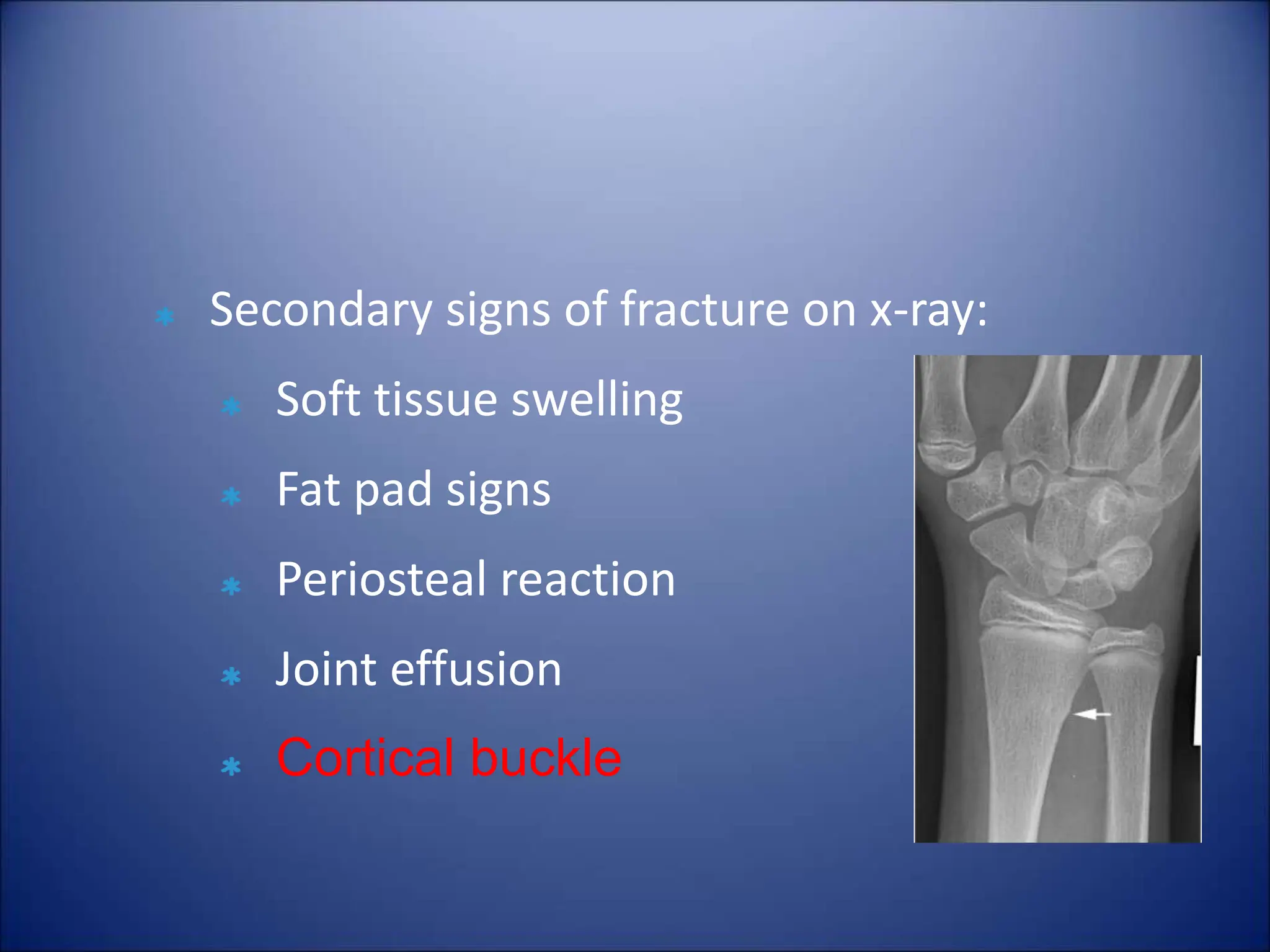 Principles of Fractures. Principle of Fractures | PPT